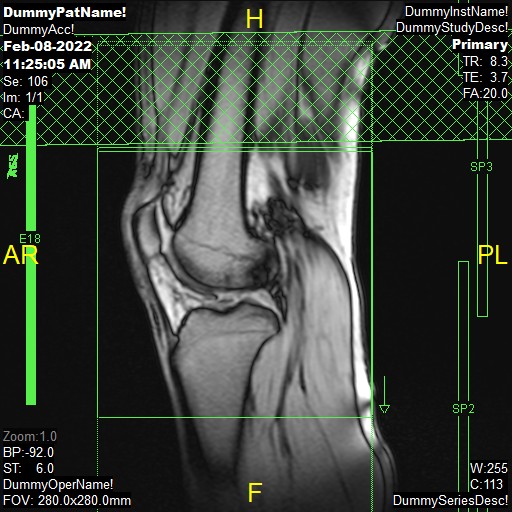 MRI RIGHT KNEE - AskRadiographerDotCom