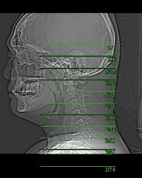CT CERVICAL SPINE - AskRadiographerDotCom