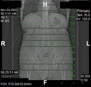 CT RENAL WITH CONTRAST - 4 PHASES PROCOTOL - AskRadiographerDotCom