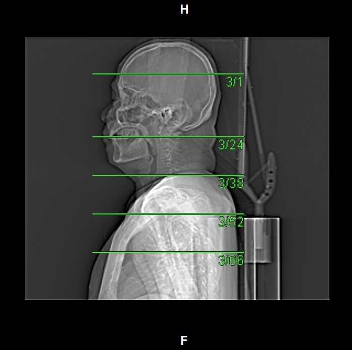 CTA CAROTID ARTERY - AskRadiographerDotCom