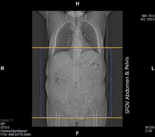 CT PARANASAL SINUS (PNS) WITH CONTRAST - AskRadiographerDotCom