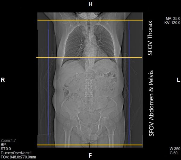CT THORAX, ABDOMEN AND PELVIS (TAP) WITH CONTRAST - AskRadiographerDotCom