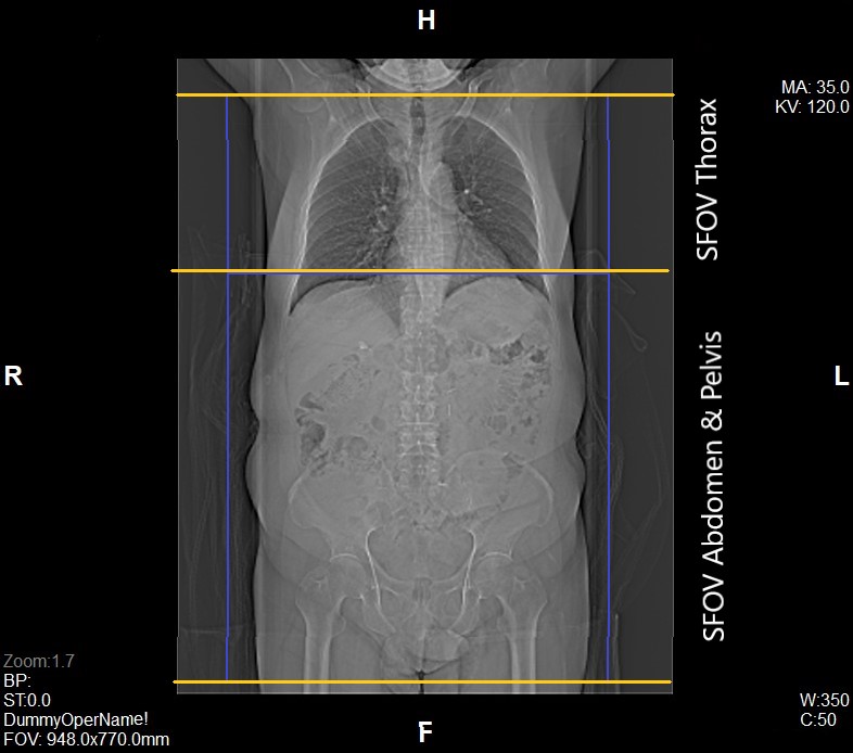 CT THORAX, ABDOMEN AND PELVIS (TAP) WITH CONTRAST - AskRadiographerDotCom